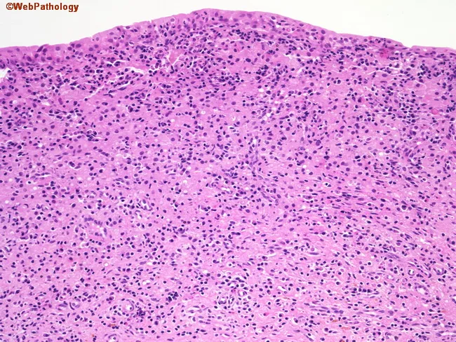 Malakoplakia of Bladder