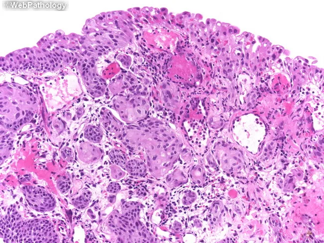 Radiation Cystitis : Pseudocarcinomatous Hyperplasia