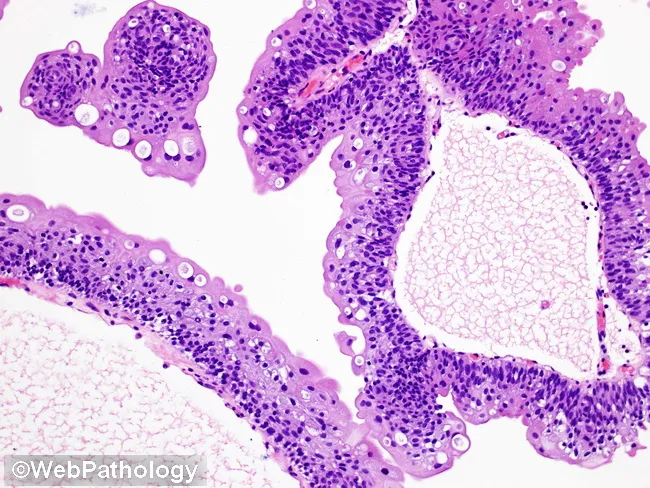 Urothelial Papilloma