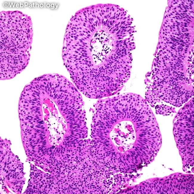 Papillary Urothelial Neoplasm of LMP