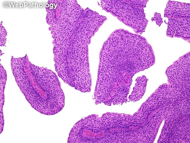 Papillary Urothelial Neoplasm of LMP