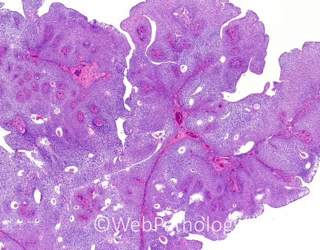 Papillary Urothelial Neoplasm of LMP