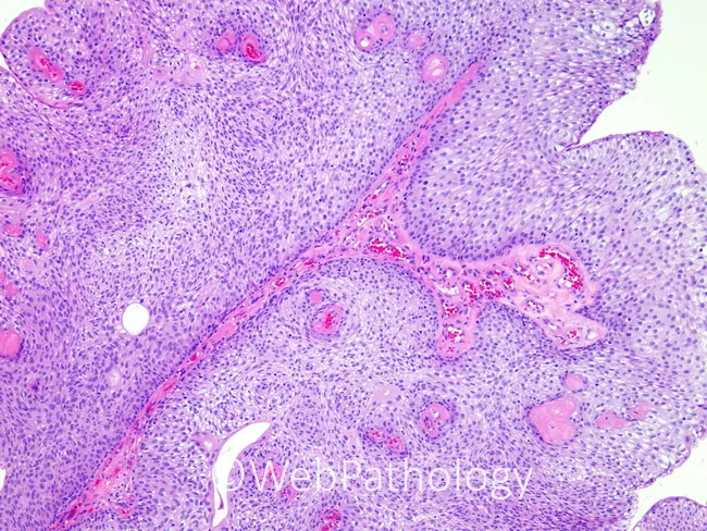 Papillary Urothelial Neoplasm of LMP
