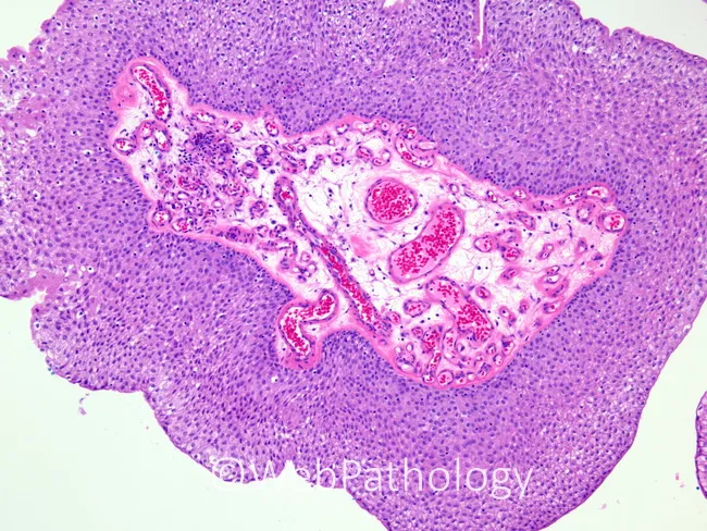 Papillary Urothelial Neoplasm of LMP