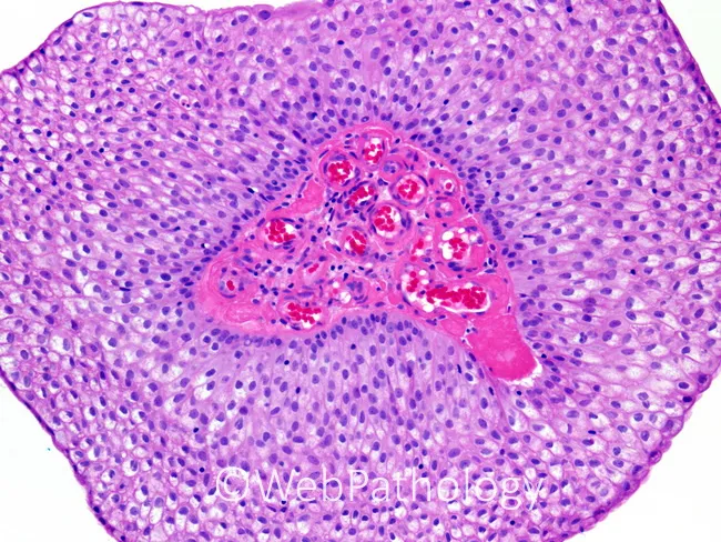 Papillary Urothelial Neoplasm of LMP