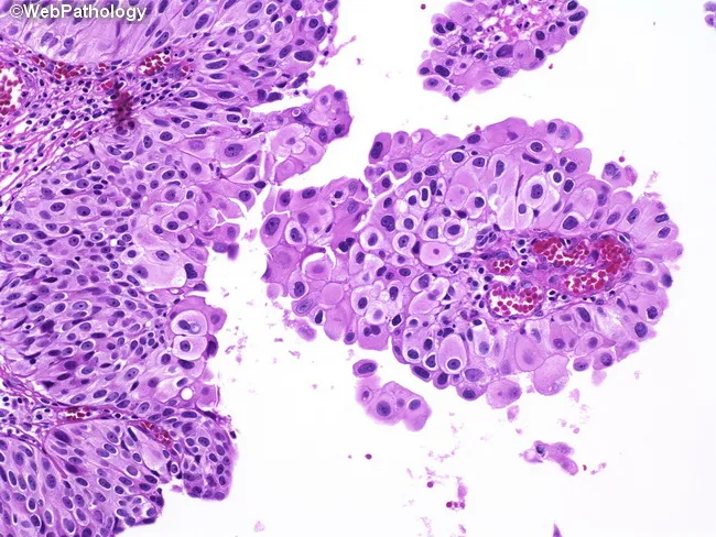Papillary Urothelial Carcinoma, High Grade