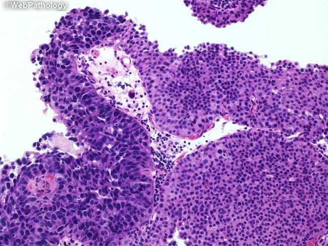 Papillary Urothelial Carcinoma, High Grade