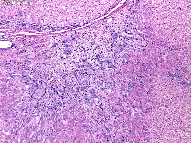 Focal Nodular Hyperplasia Pathology Outlines