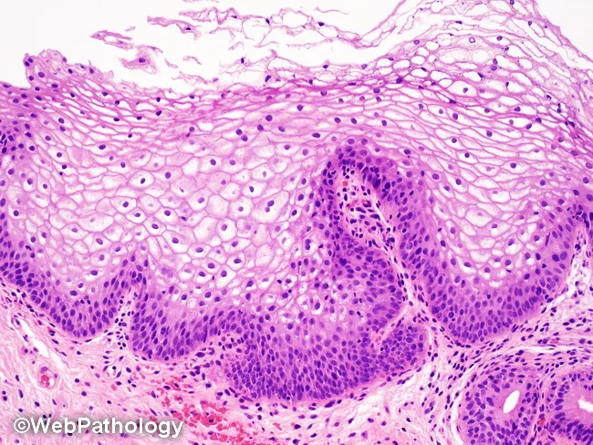 Non-keratinizing Squamous Metaplasia