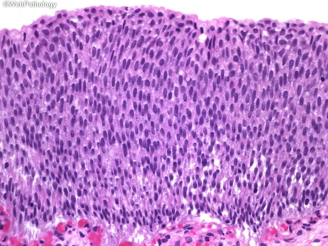 Flat Urothelial Hyperplasia
