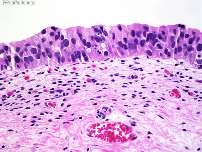 Urothelial Carcinoma-In-Situ