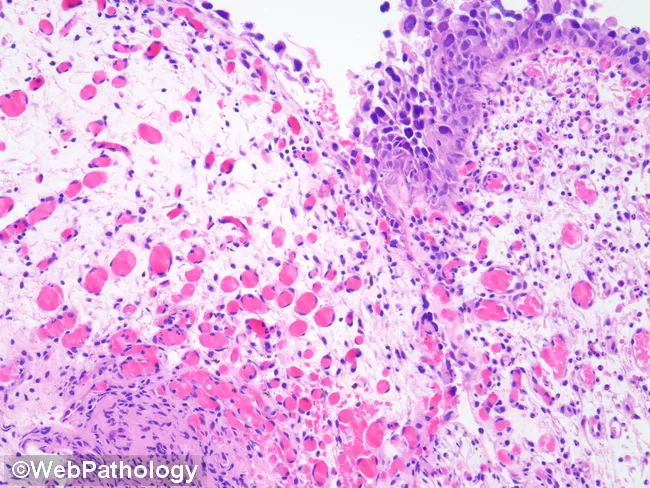 Urothelial Carcinoma-In-Situ