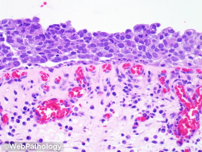 Urothelial Carcinoma-In-Situ