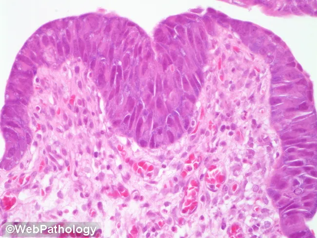 Urothelial Carcinoma-In-Situ