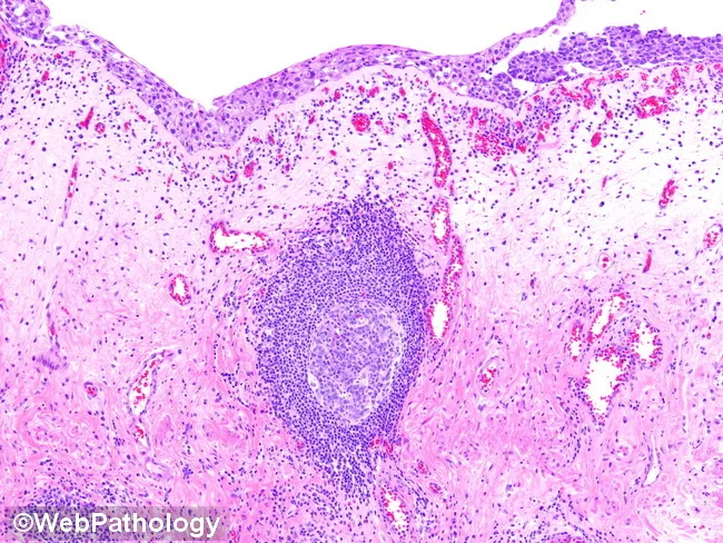 Urothelial Carcinoma-In-Situ