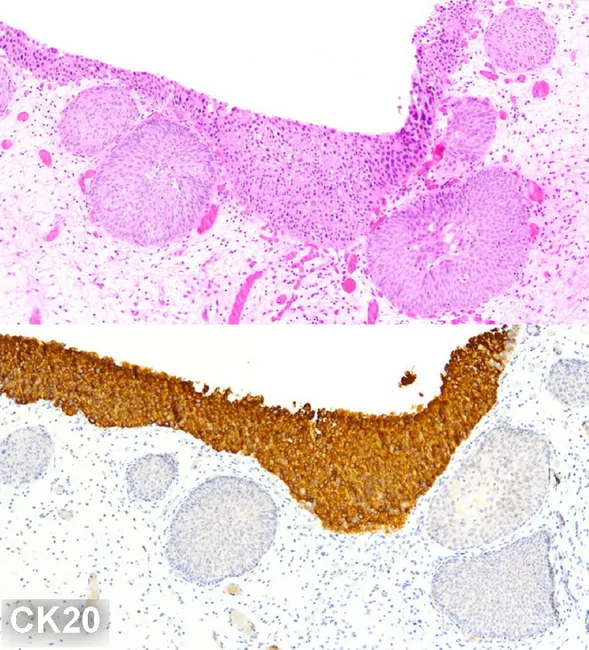 Urothelial Carcinoma-In-Situ : CK20