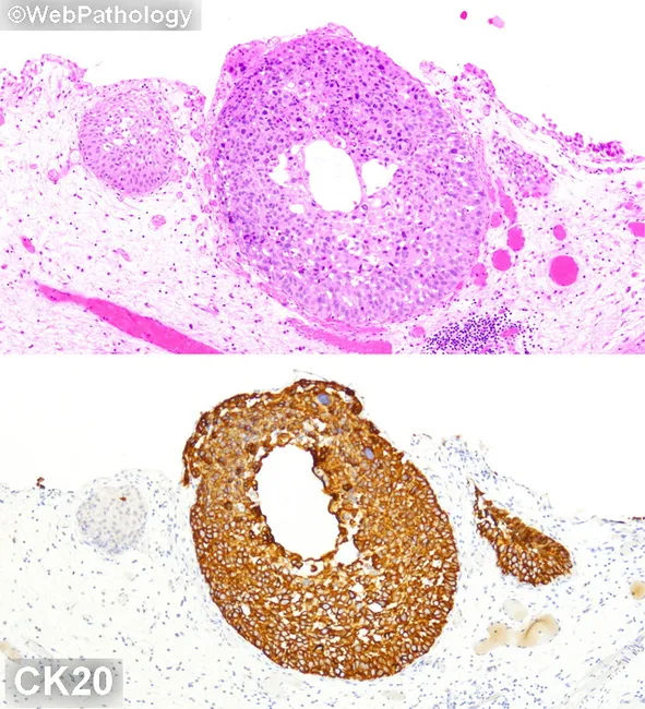 Urothelial Carcinoma-In-Situ : CK20