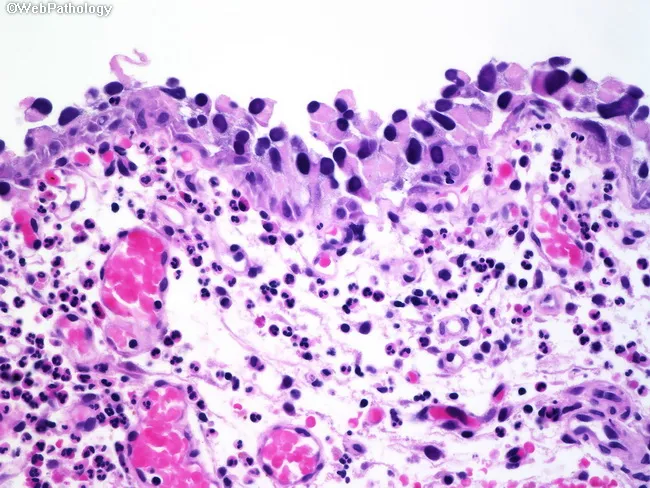 Urothelial Carcinoma-In-Situ