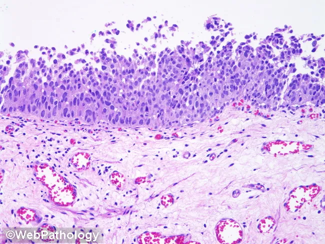 Urothelial Carcinoma-In-Situ