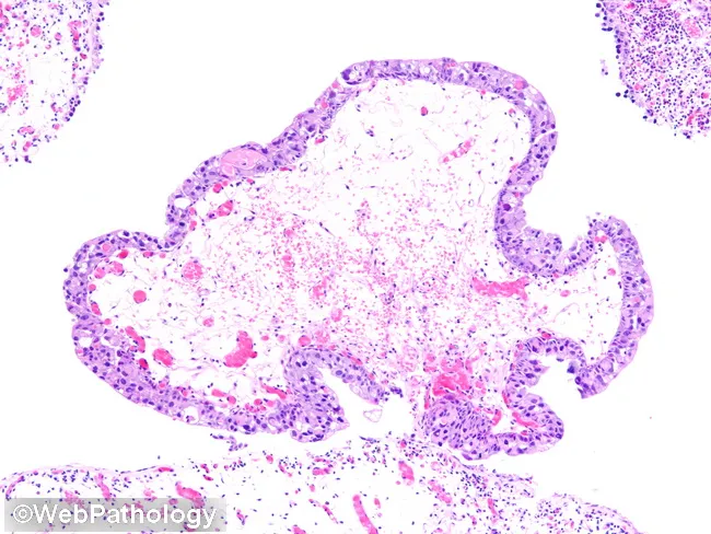 Urothelial Carcinoma-In-Situ