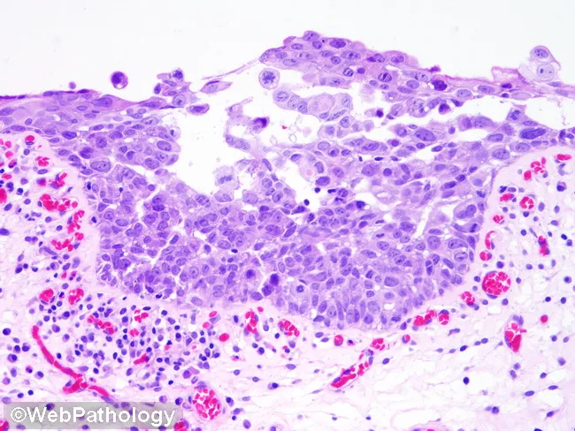 Urothelial Carcinoma-In-Situ