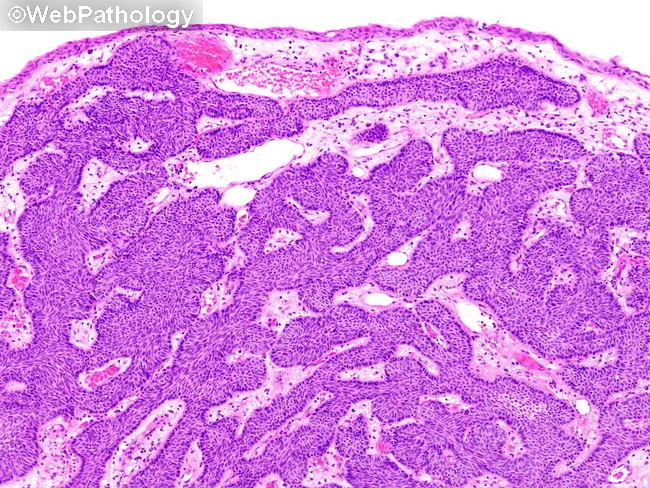 Inverted Urothelial Papilloma : Introduction