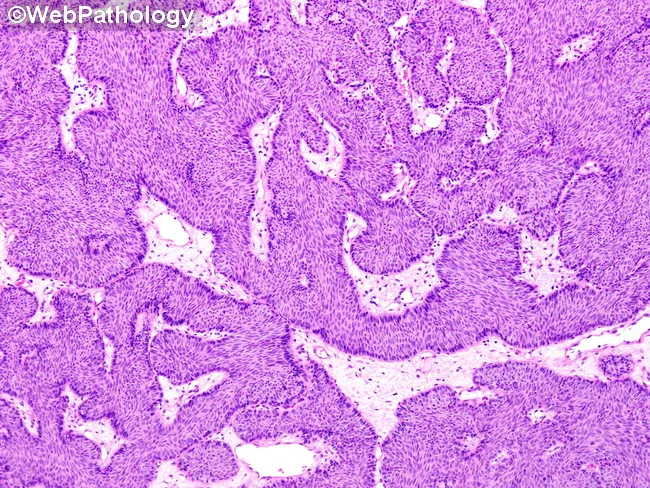 Inverted Urothelial Papilloma : Microscopic Features