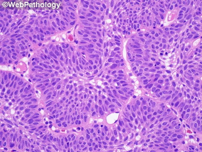 Inverted Urothelial Papilloma : Microscopic Features