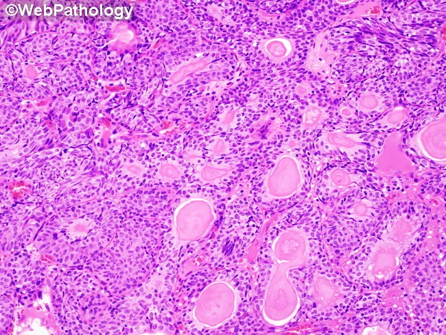 Inverted Urothelial Papilloma : Microscopic Features