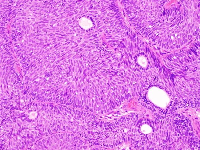 Inverted Urothelial Papilloma : Microscopic Features