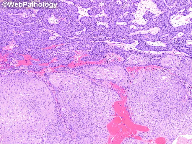 Inverted Urothelial Papilloma : Microscopic Features