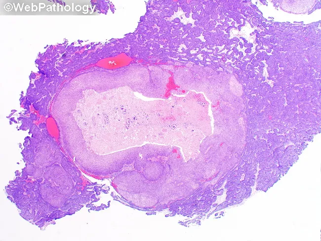 Inverted Urothelial Papilloma : Microscopic Features
