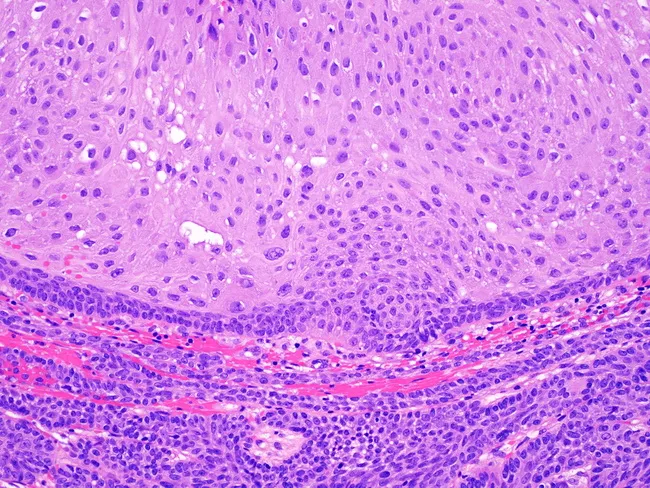Inverted Urothelial Papilloma : Microscopic Features