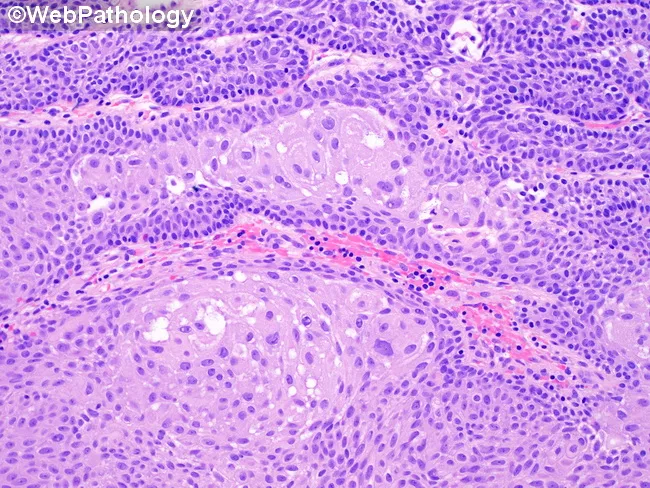 Inverted Urothelial Papilloma : Microscopic Features