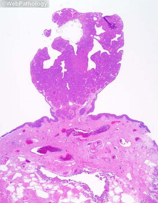 Inverted Urothelial Papilloma : Microscopic Features