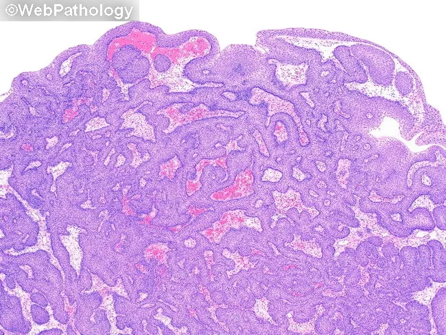 Inverted Urothelial Papilloma : Microscopic Features