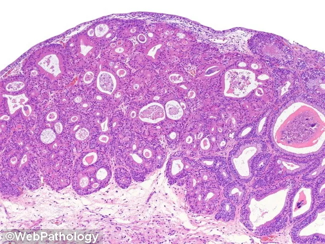 Inverted Urothelial Papilloma : Differential Diagnosis