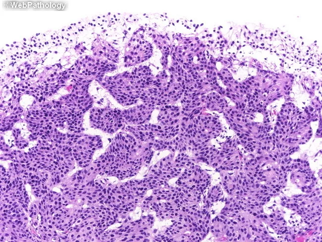 Inverted Urothelial Papilloma : Differential Diagnosis