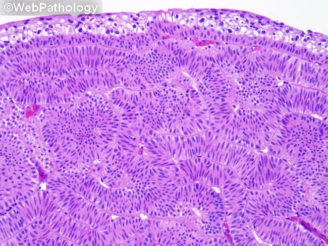 Inverted Urothelial Papilloma