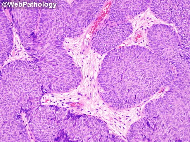 Inverted Urothelial Papilloma