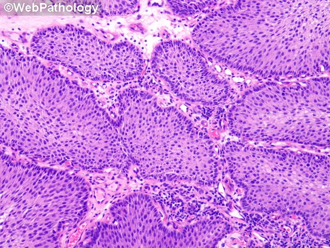 Inverted Urothelial Papilloma