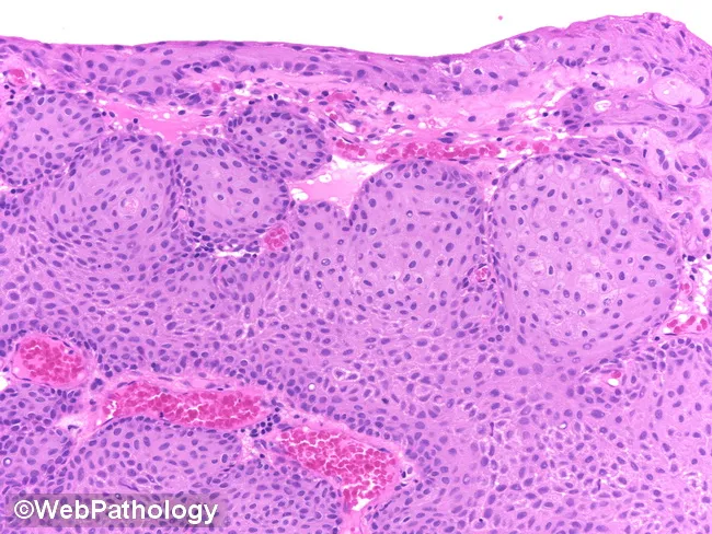 Inverted Urothelial Papilloma