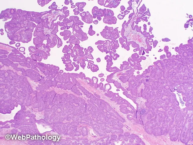Inverted Papillary Urothelial Neoplasm of LMP : Microscopic