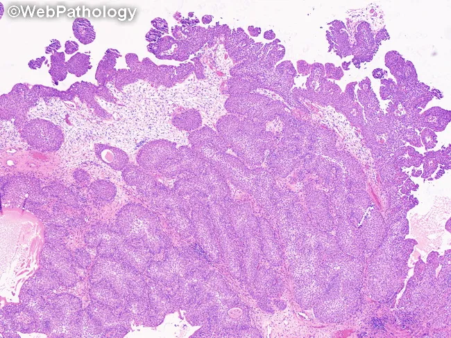 Inverted Papillary Urothelial Neoplasm of LMP : Microscopic