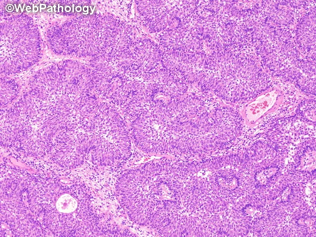 Inverted Papillary Urothelial Neoplasm of LMP : Microscopic