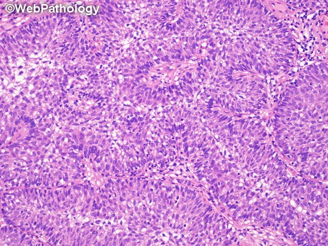 Inverted Papillary Urothelial Neoplasm of LMP : Prognosis