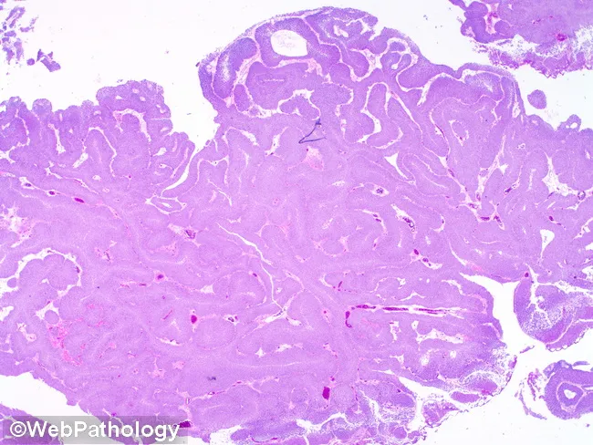 Inverted Papillary Uroth. CA, Low-Grade : Microscopic
