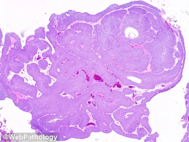 Inverted Papillary Uroth. CA, Low-Grade : Microscopic