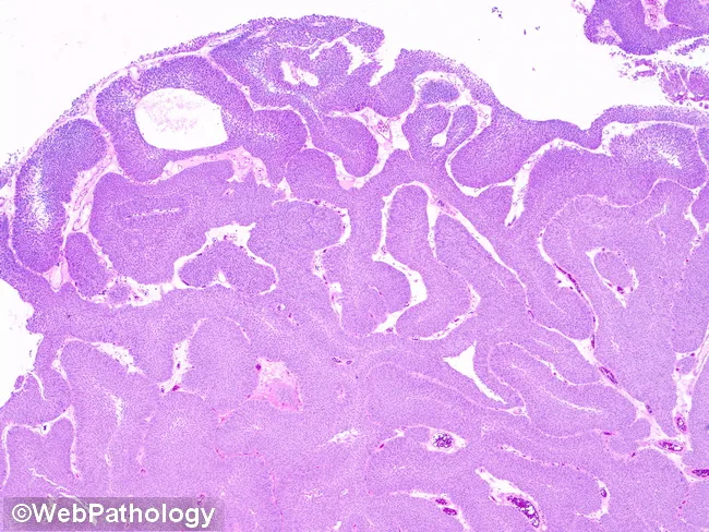 Inverted Papillary Uroth. CA, Low-Grade : Microscopic