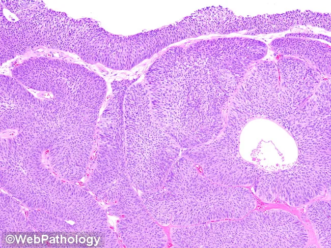Inverted Papillary Uroth. CA, Low-Grade : Microscopic